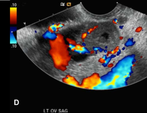Color Doppler Transvaginal Imaging Through The Left Ovary Demonstrates